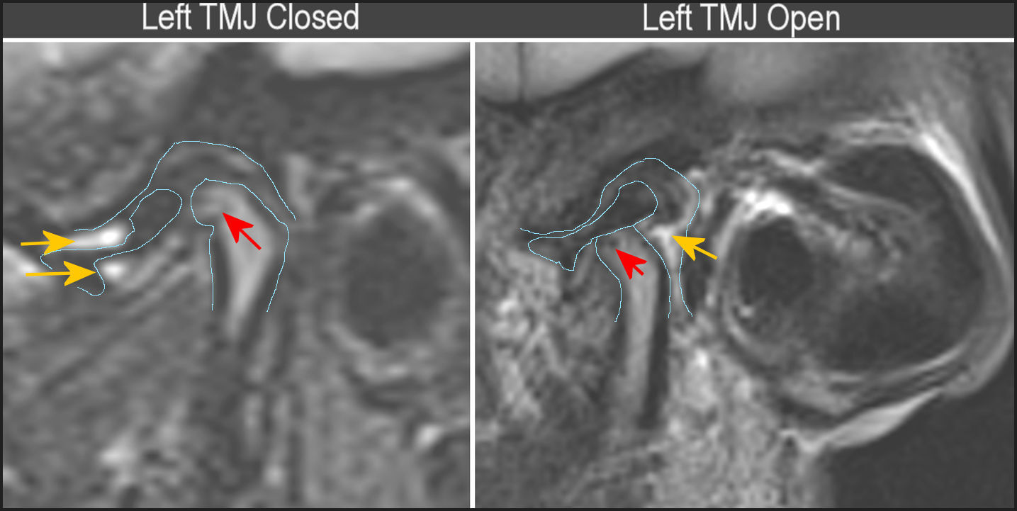 Joint Vibration Analysis (JVA) Bridges the Gap between Clinical ...